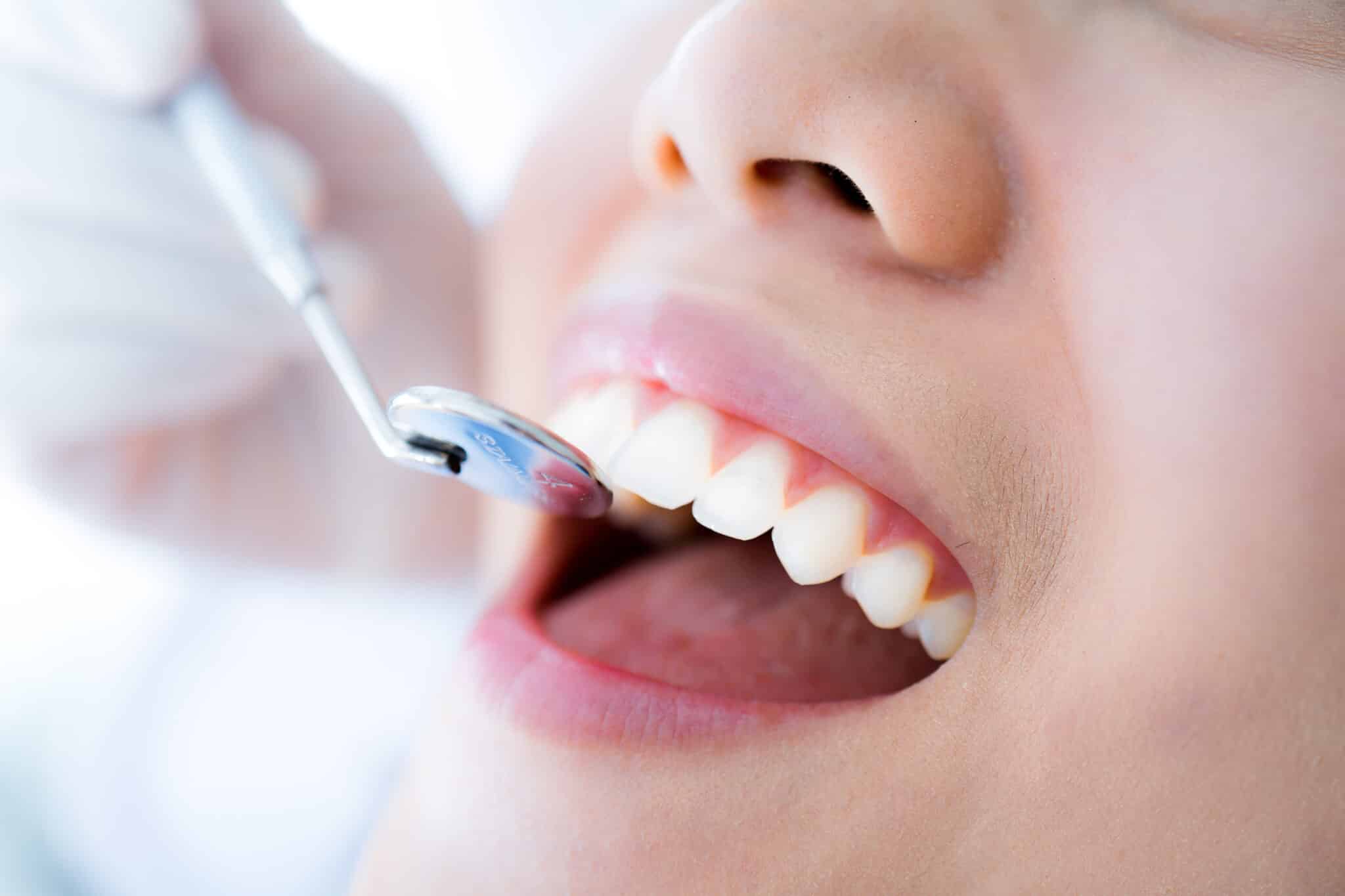 Fillings vs. Inlays vs. Onlays: Which Is Best for You?